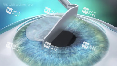 ICL/TICL/PRL晶体植入怎么选？从矫正范围到适用人群，三大术式核心区别全解析 - 耐看网